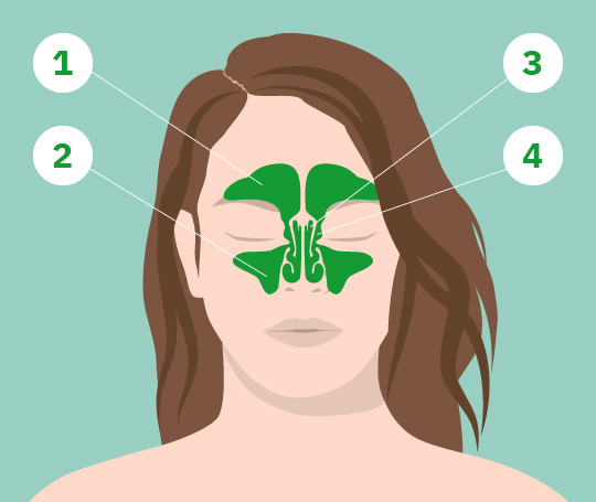 Akute und chronische Pansinusitis: Was ist das? | GeloMyrtol® forte