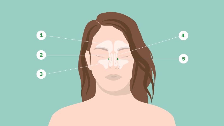 Alles über die Polypöse Sinusitis | GeloMyrtol® forte